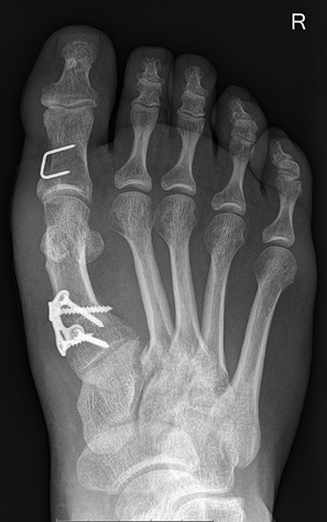 Hallux valgus - Rijnland Orthopaedie